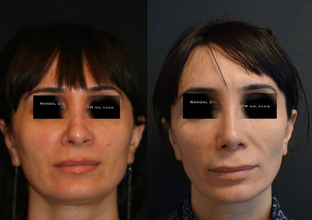 Open versus closed rhinoplasty | Dr. Haworth