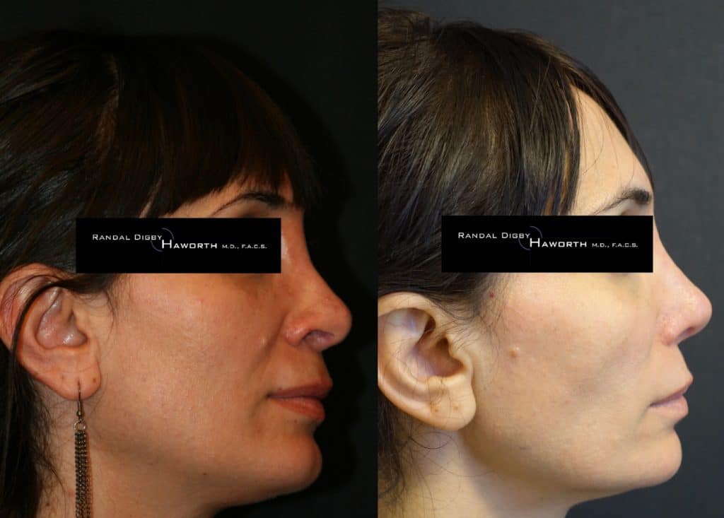 Open versus closed rhinoplasty | Dr. Haworth