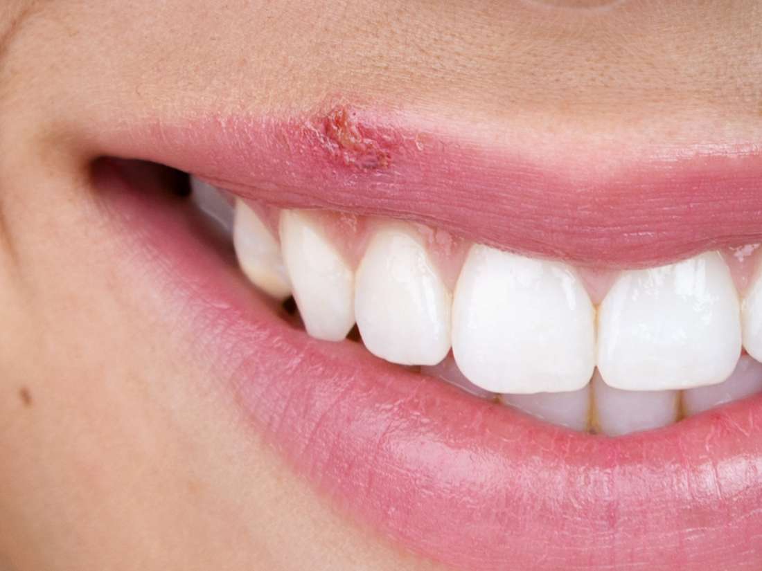 Herpes On Corner Of Lip